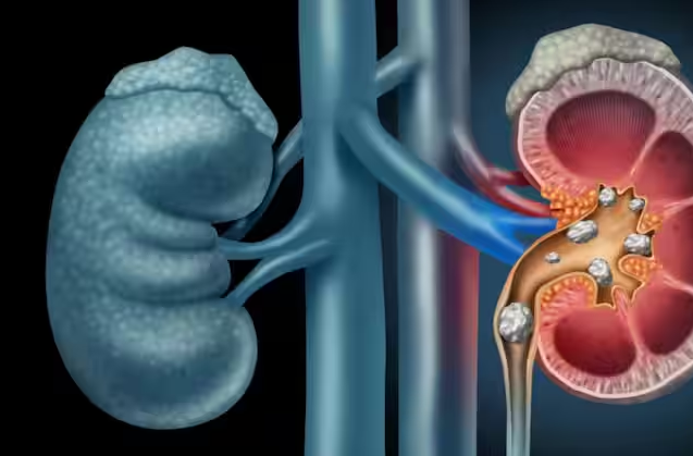 This lentil is fed to patients suffering from kidney stones, you will ...