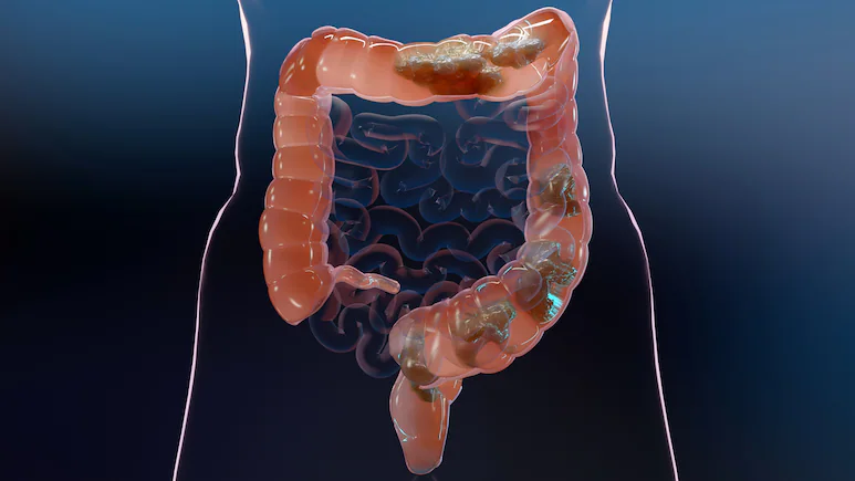 Intestinal Dirt Can Ruin Digestion — These 5 Habits Cause It, and Here ...